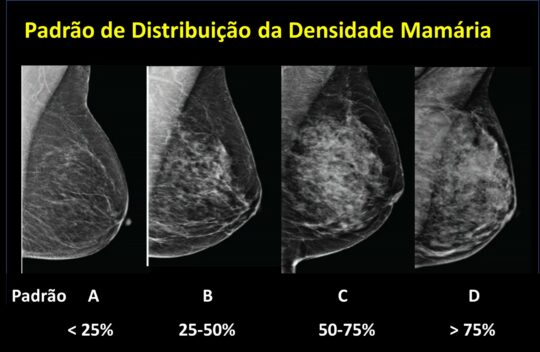 Atualização do BI‑RADS 2025: mais precisão e clareza no laudo de ...